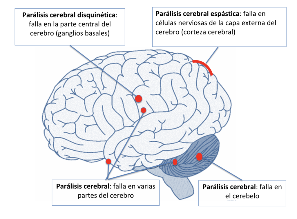 ¿Qué es la Parálisis Cerebral? ¡Porque Puedes! Blog Fisioterapia México